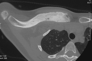 Tietze's Syndrome | SpringerLink