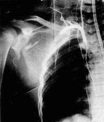 Scapulothoracic Dissociation | SpringerLink