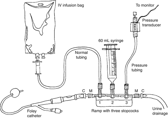 Intraabdominal Pressure Monitoring | SpringerLink