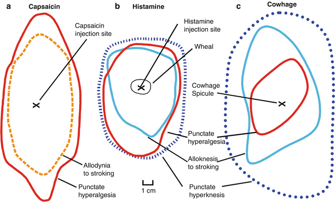 Allodynia and Alloknesis | SpringerLink