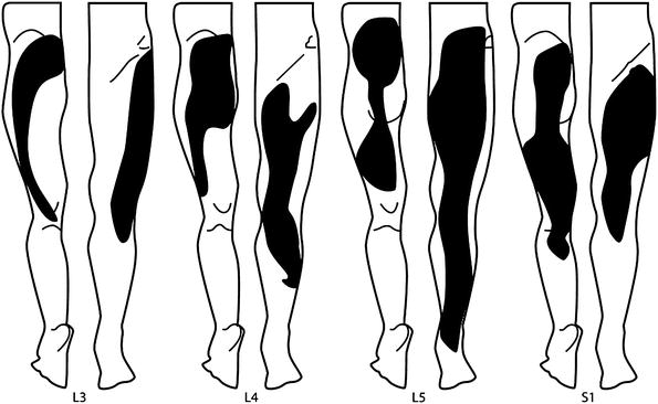 Somatic Referred Pain | SpringerLink