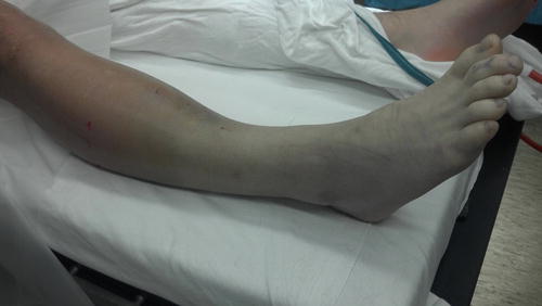 Crush Injuries | SpringerLink