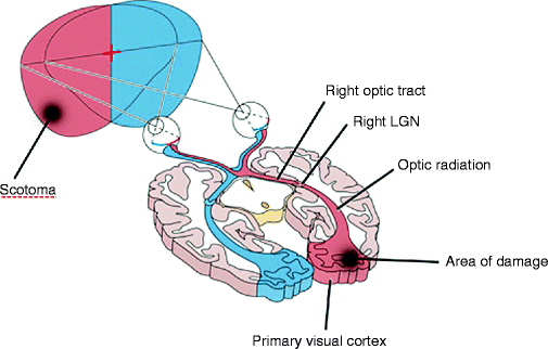 Blindsight | SpringerLink