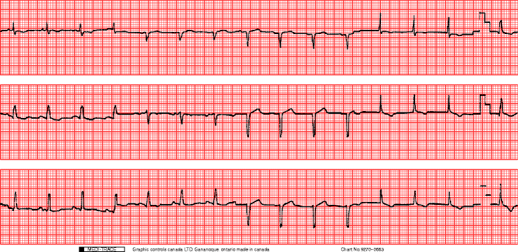 Myocardial Infarction | SpringerLink