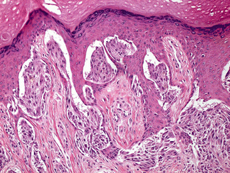 Spitz Nevus | SpringerLink