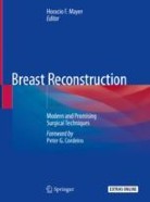 Profunda Artery Perforator Flaps for Breast Reconstruction | SpringerLink