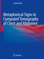 Consolidation, Bulging Fissure Sign or Lobar Consolidation and Air ...