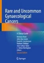 Endometrial Stromal Sarcoma | Springer Nature Link