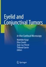 Eyelid and Conjunctival Tumors: In Vivo Confocal Microscopy | SpringerLink