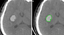 Predicting hematoma expansion after intracerebral hemorrhage: a comparison of clinician ...