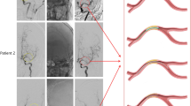 Intracranial Rescue Stenting in Pediatric Focal Cerebral Arteriopathy ...