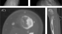 Update of pediatric bone tumors—notochordal tumors, chondrogenic tumors ...