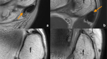 Association between flat variants of the peroneus brevis tendon and ...