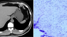 Thick calcification from a GIST of the stomach penetrating into ...