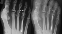Treatment of Morton’s neuroma with minimally invasive distal metatarsal ...