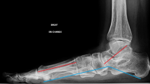 Retrocalcaneal Spur Noted