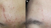 Combination of W-plasty and Botulinum Neurotoxin Type A Injection for ...