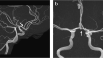 Dual fenestration of the A1 and azygos A2 segments of the anterior ...