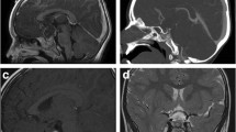 Clinical features of intrasellar meningiomas treated with endoscopic ...