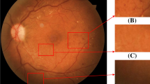FQ-Conv-ViT: A quantized convolutional vision transformer model for diabetic retinopathy ...