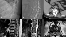 Differentiation of typical features between Fungal spondylitis and ...