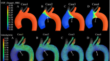 Ultrasound vector flow imaging during veno-arterial extracorporeal ...