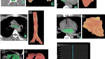 Layering of stomach contents in drowning cases in post-mortem computed ...