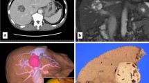Multicystic biliary hamartoma: imaging findings in four cases ...