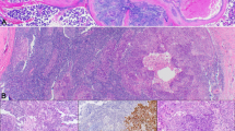 Malignant Transformation of Parotid Gland Non-sebaceous Lymphadenoma ...