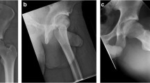 Approach to the Failed Hip Surgery | SpringerLink