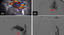 Acquired uterine arteriovenous malformation: efficacy of the use of ...