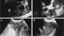 A Practical Approach to Pneumothorax Management | Pulmonary Therapy