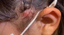 Cutaneous Myiasis | Current Infectious Disease Reports
