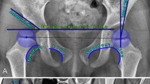 Skeletally Mature Acetabular Dysplasia: Anatomy, Pathomorphology ...