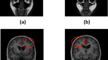 Unilateral perirolandic polymicrogyria with ipsilateral brainstem ...