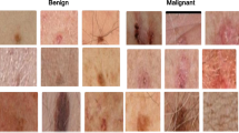 A robust deep learning framework for multiclass skin cancer ...