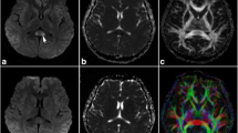 Some novel causes and clinical characteristics of reversible splenial ...