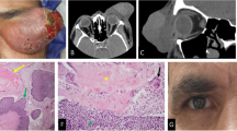 Beyond the Surface of Giant Pilomatricoma: A Rare Skin Tumor with ...