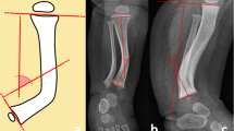 The Bowed Tibia | SpringerLink