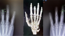 Long-term outcome of dorsal digital defect reconstruction using reverse ...