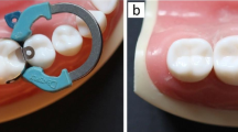 Effect of matrix system on the quality of proximal contact in posterior ...