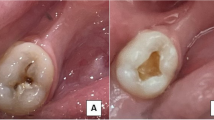 Clinical performance of two chemomechanical caries removal agents in ...