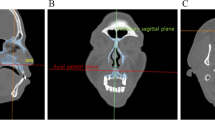 Morphometric Analysis of Pterygomaxillary Fissure in Dry Skulls and its ...