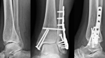 One-third tubular plates versus anatomical distal fibula plates in ...