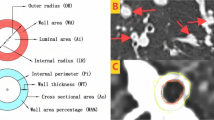 Quantitative CT of emphysema, wall thickness and mucus plugs in alpha-1 ...