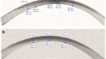 Collagen cross-linking in keratoconus in Asian eyes: visual, refractive ...