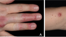 Gouty finger flexor tenosynovitis with urate milk remarkably similar to ...