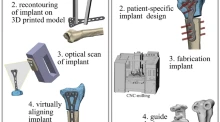 3D surgical planning and patient-specific implants in orthopaedic trauma surgery | SpringerLink