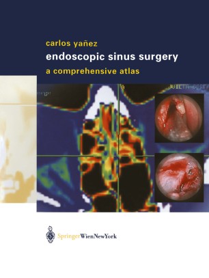 Endoscopic Sinus Surgery | SpringerLink