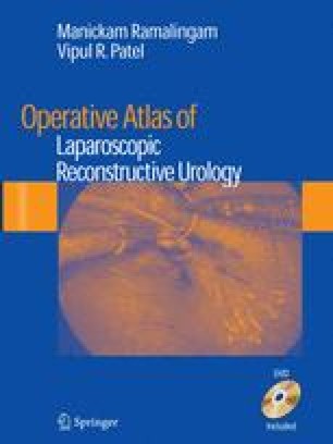 Laparoscopic Boari Flap Ureteric Reimplantation | SpringerLink